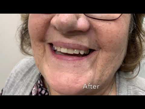 Single Tooth Denture | One tooth denture solution