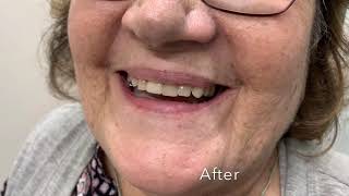 Single Tooth Denture | One tooth denture solution