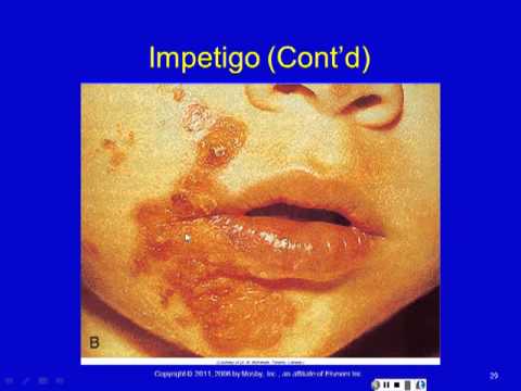Skin Disorders