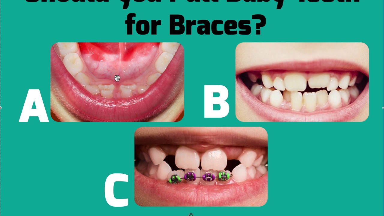 Should you Pull Baby Teeth for Braces or Invisalign