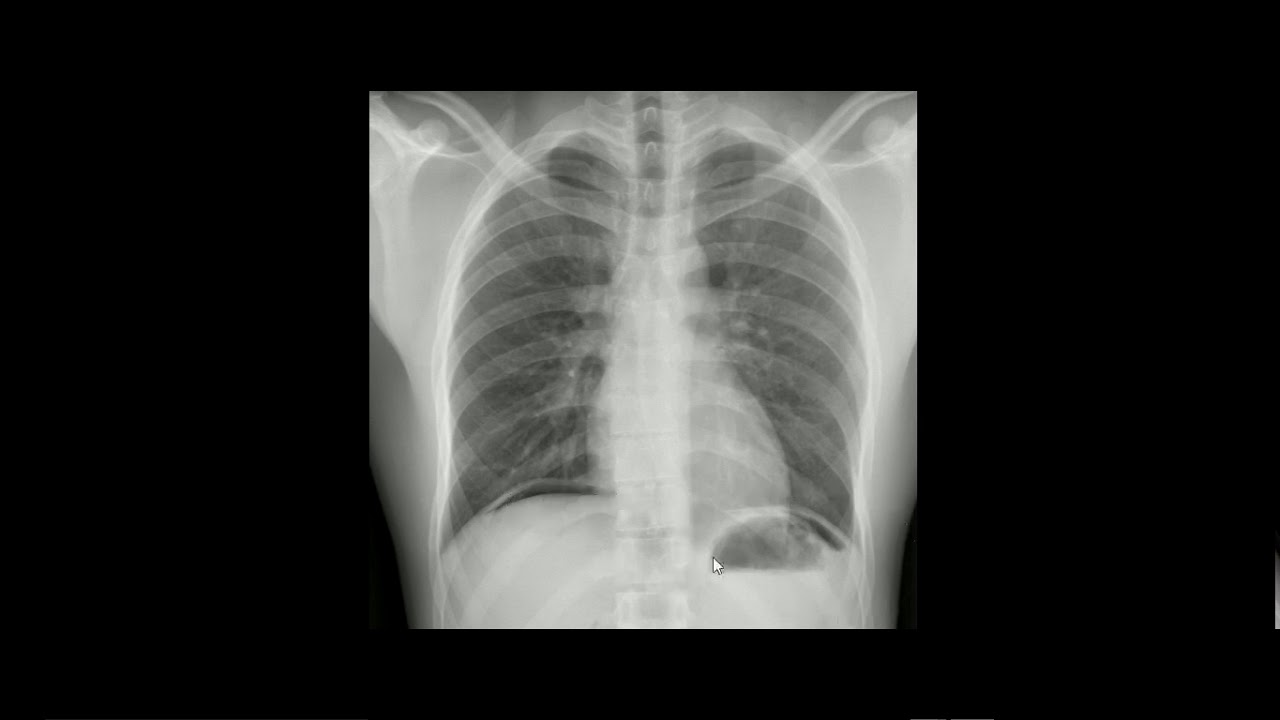 Pneumoperitônio
