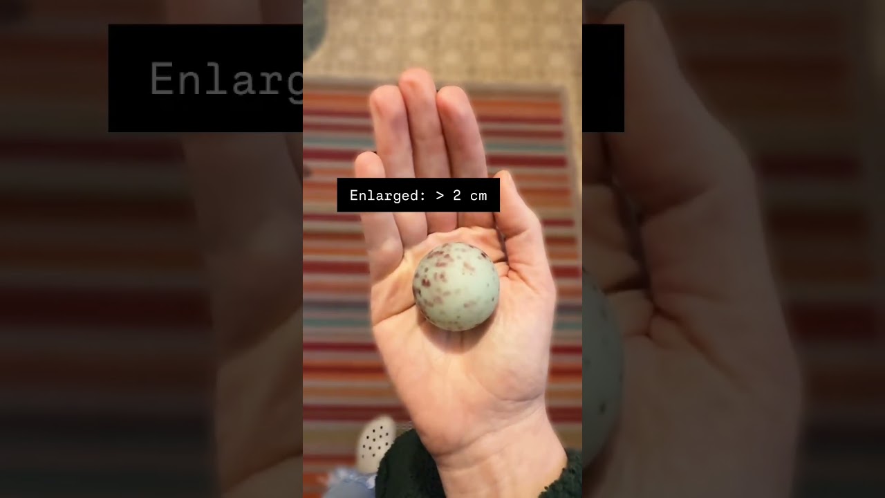 What’s normal and what’s not? #lymph #lymphnodes #lymphlove