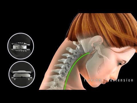 Artificial Disc for Cervical Disc Replacement | Bumrungrad