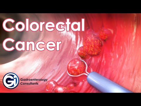 Colorectal Cancer | Gastroenterology Consultants