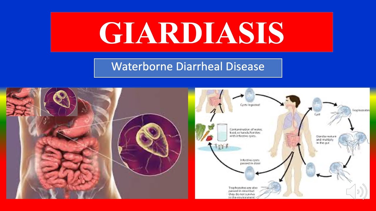 GIARDIASIS - Definition, types, causes, pathophysiology, symptoms , treatment , medicine