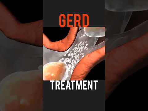 Gastroesophageal reflux disease (GERD) Treatment #shortscommunity
