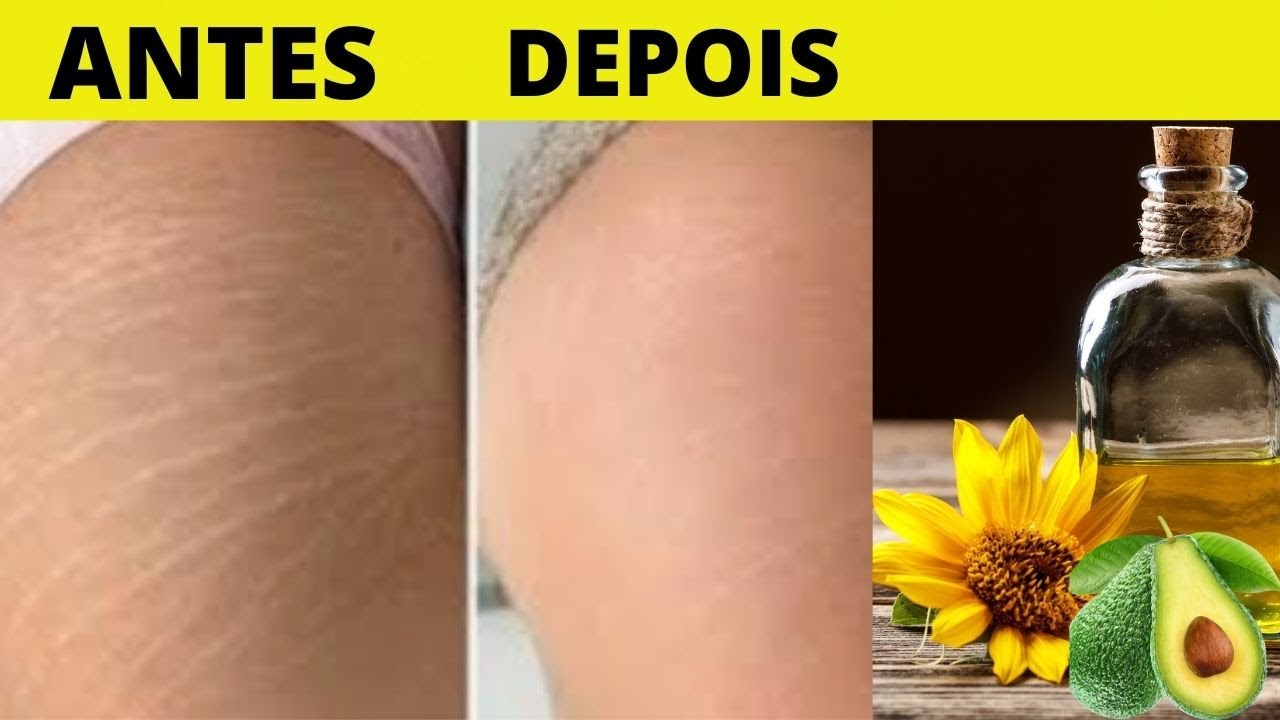 Tratamento Caseiro Para Estrias Brancas