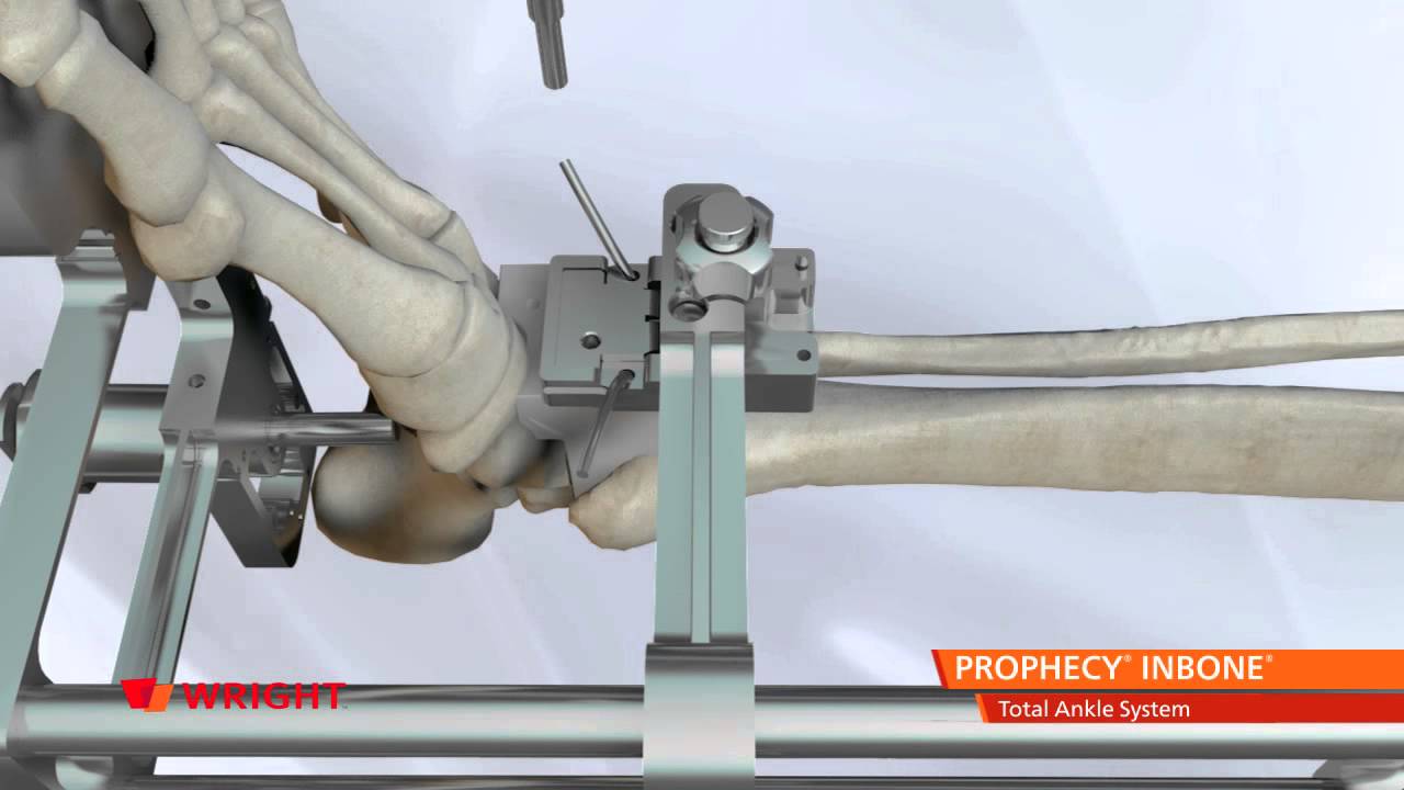 PROPHECY™ INBONE™ Preoperative Navigation System Animation