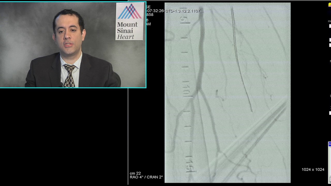 Peripheral Interventions - January 27, 2016