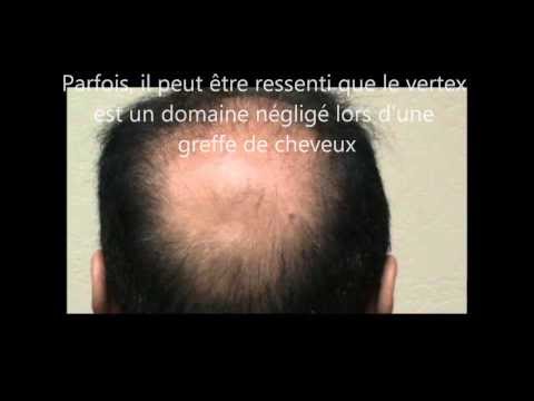 Traitement du vertex – Hattingen Hair. Greffe de cheveux