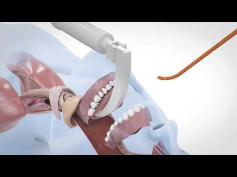 Bougie - Tracheal Tube Introducer Latest Price, Manufacturers & Suppliers