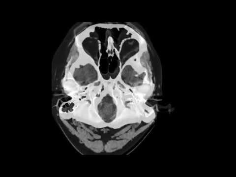CT OF HEAD/BRAIN WITH AND WITHOUT CONTRAST