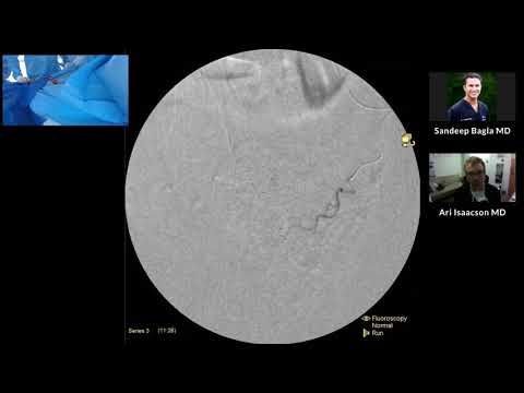 PAE: Live Radial Prostatic Artery Embolization with Dr. Bagla