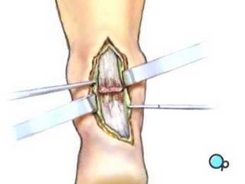 PreOp® Patient Education: Achilles Tendon Repair Surgery