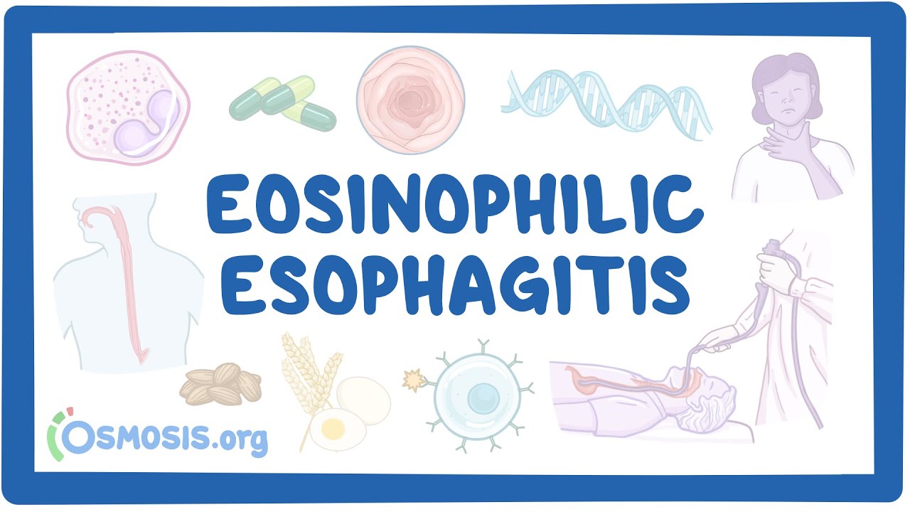 Eosinophilic esophagitis (NORD)