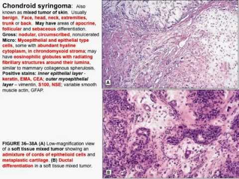 BST-Soft tissue pathology101-Uncertain types.mov