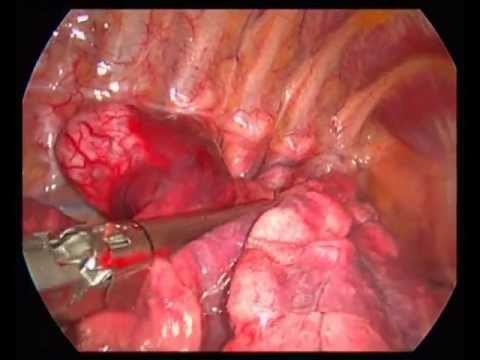 VATS Hamartoma of the lung