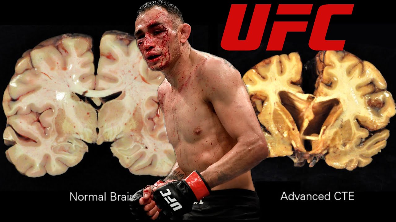 How CTE is plaguing the UFC