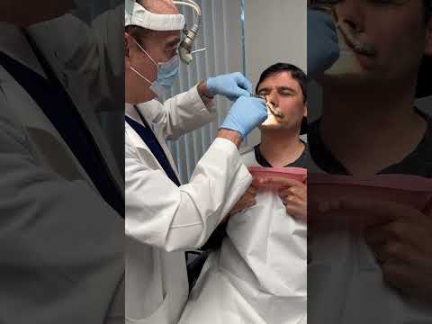 Nasal splint removal 7 days after a septoplasty-no discomfort