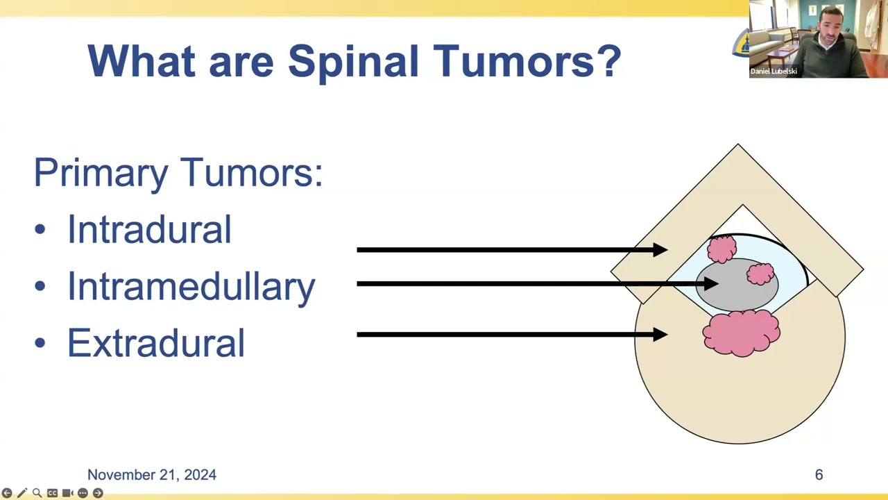 Understanding and Treating Spinal Tumors