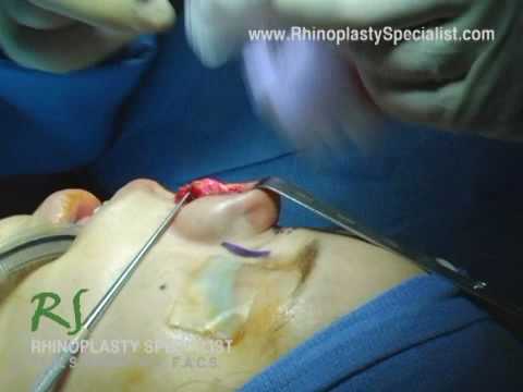 OR Video Footage: Exposing the Nasal Anatomy