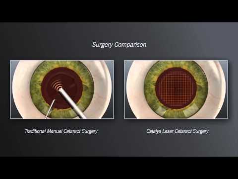 OptiMedica® Catalys™ Precision Laser System for Cataract Surgery