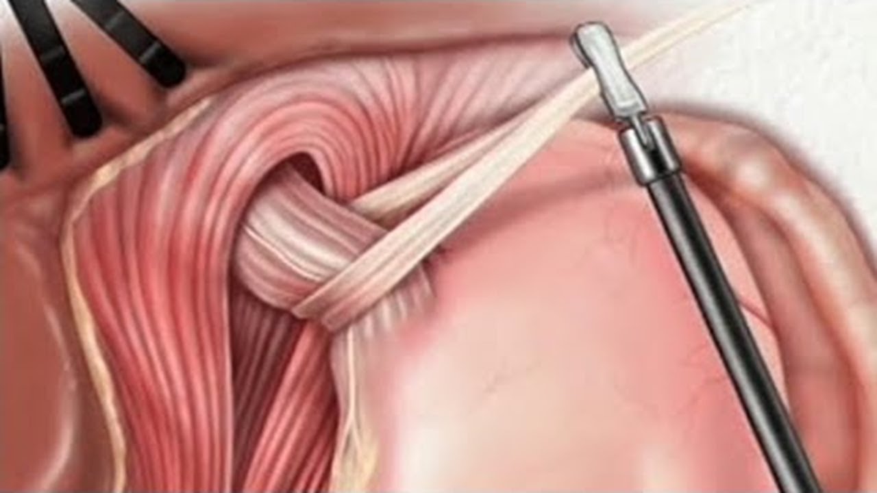 PreOp® Hiatal Hernia – Laparoscopic 🏋🏥😕