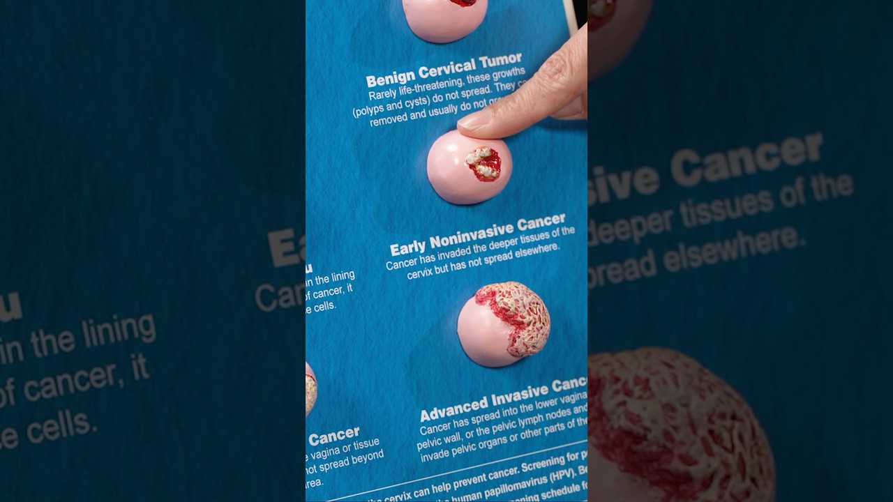 Stages of cervical cancer - From benign to advanced