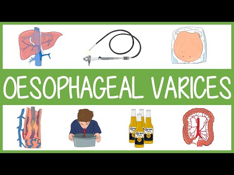 Oesophageal Varices Visually Explained