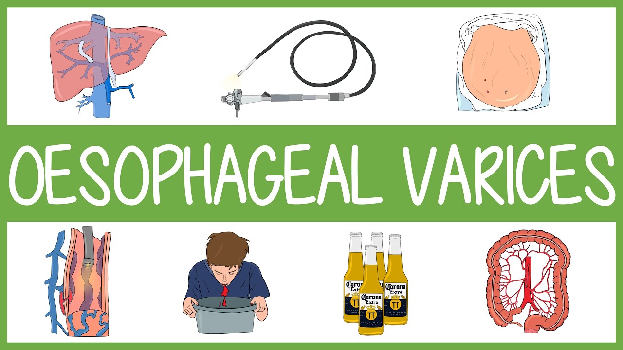 Oesophageal Varices Visually Explained