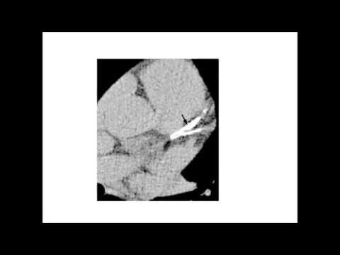 Coronary artery Ca score prediction in people with type 2 diabetes
