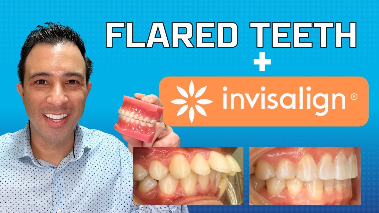 Invisalign Magic to Fix Flared Teeth WITHOUT EXTRACTION by Dr. Robert Passamano