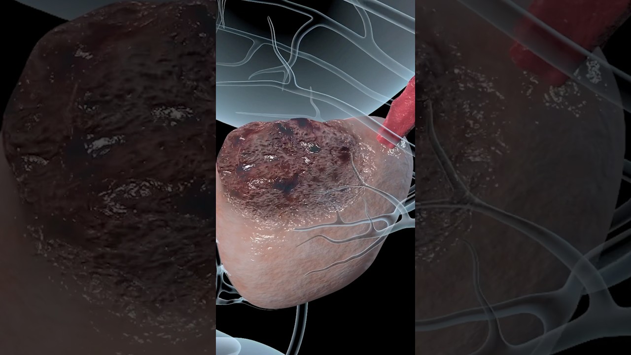 What is a PSA test for prostate cancer? Prostate-specific antigen test