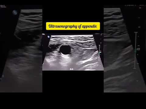 Appendix ✨#ultrasonography #health #sonography #ultrasoundscans #radiology #ultrasoundtechnologist