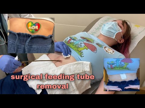 Surgical GJ feeding tube removal- medical vlog