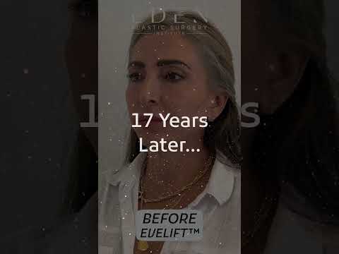 Before and After EVE Lift™ Facelift | Dr. Ali Charafeddine | Eden Plastic Surgery Miami FL