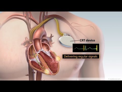 Cardiac Resynchronization Therapy