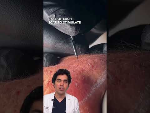 ACNE SCAR SINGLE SESSION Combination Treatment RESULTS 🙌 (TCA, Subcision, Lasers, Fillers)