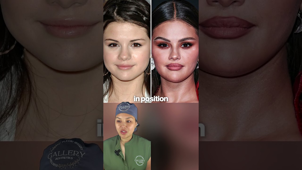 Selena Gomez Before & After Plastic Surgery 😍