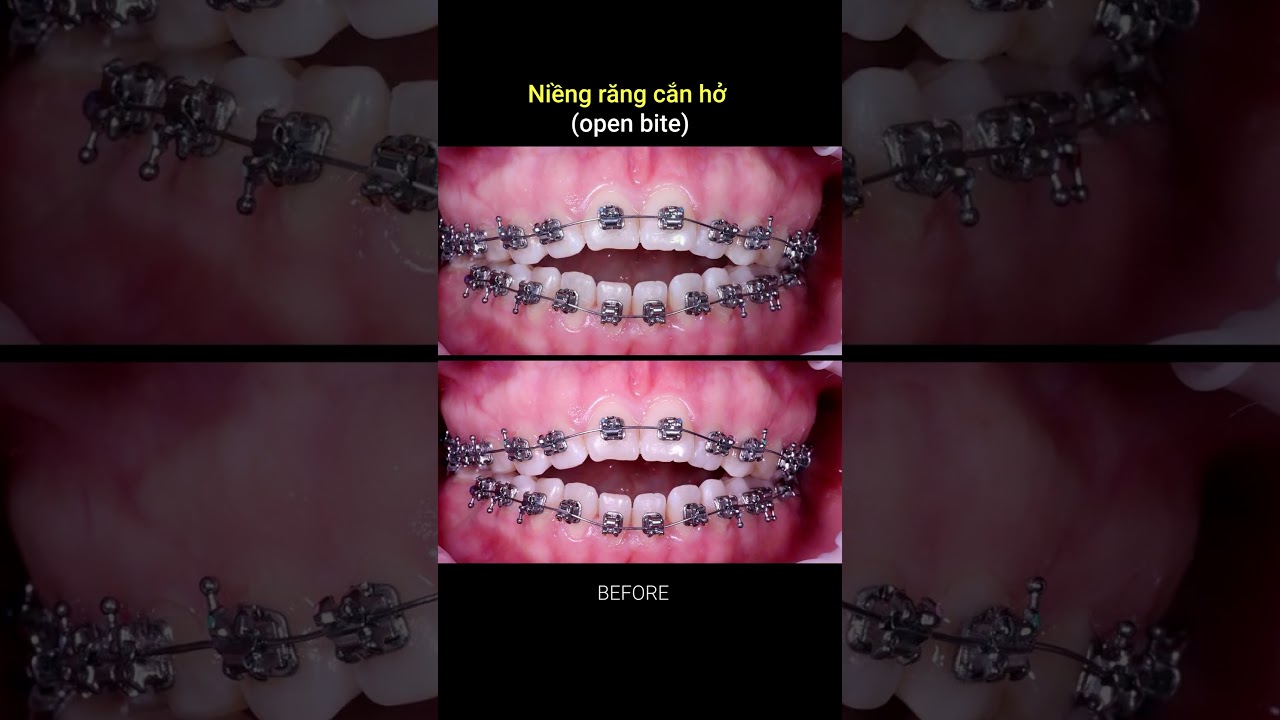 Braces process - deep bite, open bite