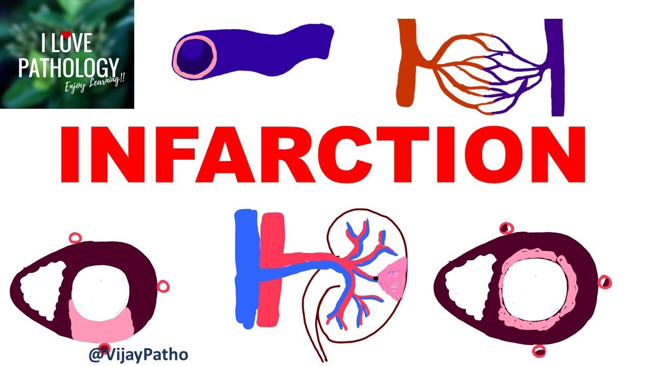 Understanding Infarction: Causes, Types, and Morphology | Galaxy.ai