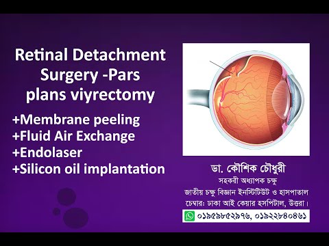Retinal detachment surgery Pars plans viyrectomy +Membrane peeling +Fluid Air Exchange +Endolaser +