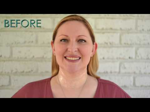 A New Image - Kybella: Before and After 1 Treatment