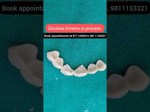 Zirconia Crowns for Front Teeth in Process; Dr. Srishti Bhatia #smilemakeover #teeth