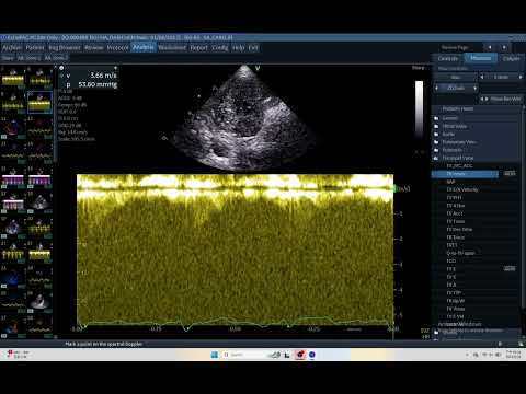 IQ 499 PAPS ECHO PAC ANALYSIS ECHOCARDIOGRAPHY