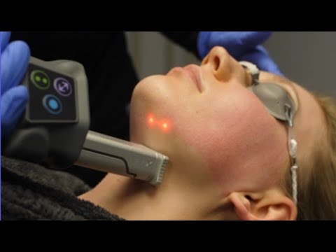 CO2 & 1570 Fusion Laser Treatment & Results