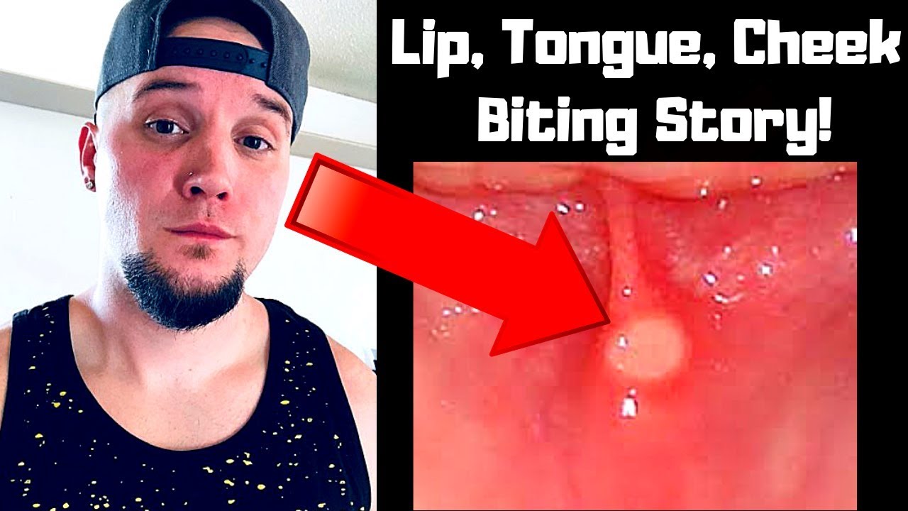 My Lip, Tongue & Cheek Biting Story! (BFRB)