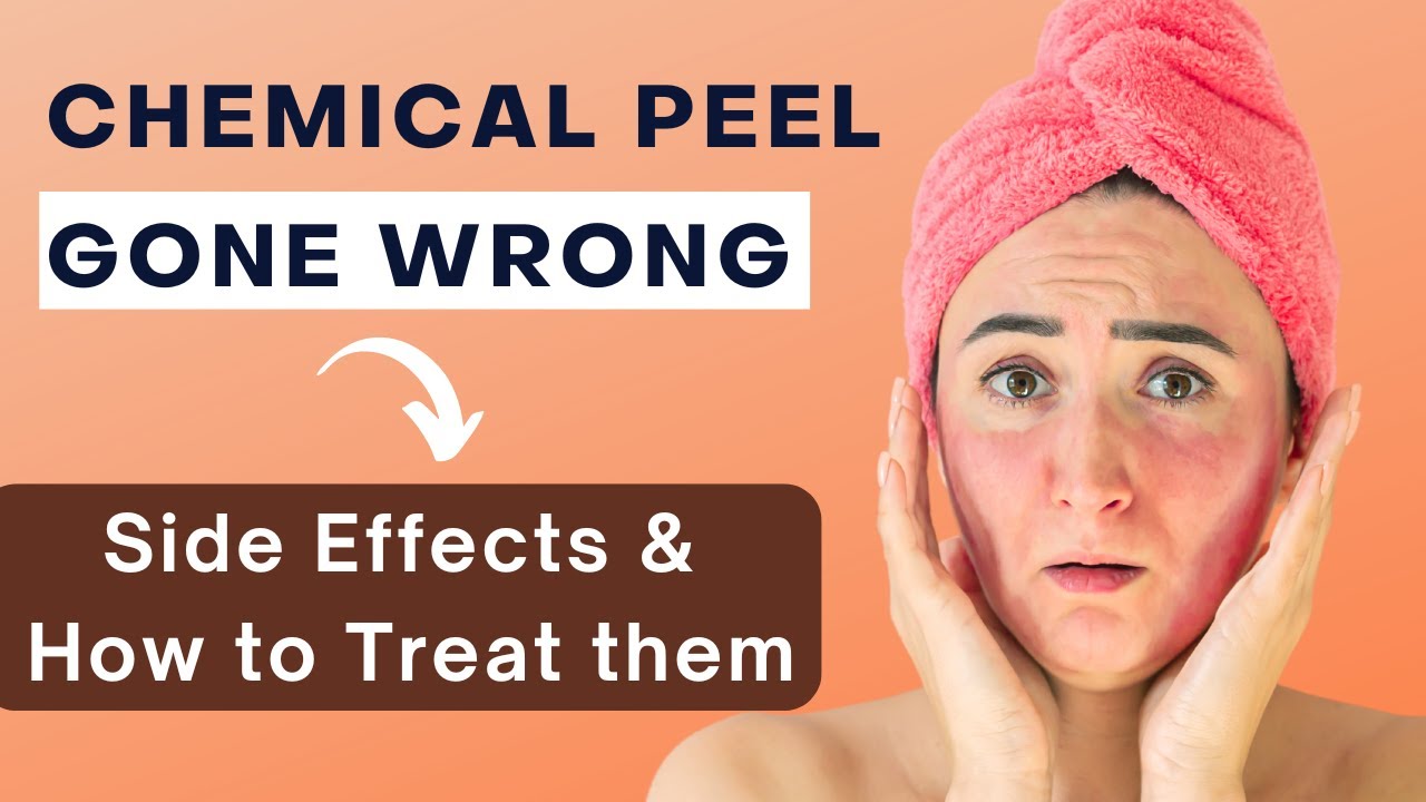Chemical Peel Gone Wrong - Side Effects & Remedies