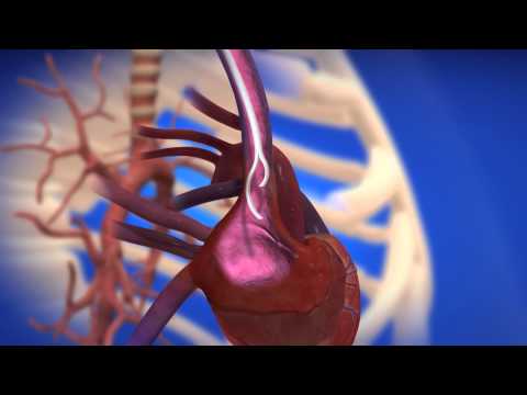 CentrosFLO® Long-Term Hemodialysis Catheter
