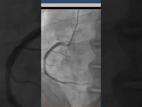 PRE LAD,D1 and OM1 multiple site stenosis #angiography #shorts #ytshorts